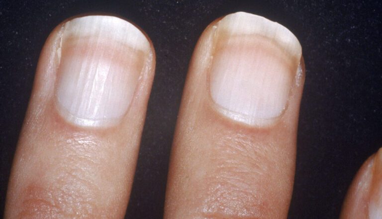 La Ausencia De La Lunula En Las Uñas: ¿Qué Significa Y Qué Indica?